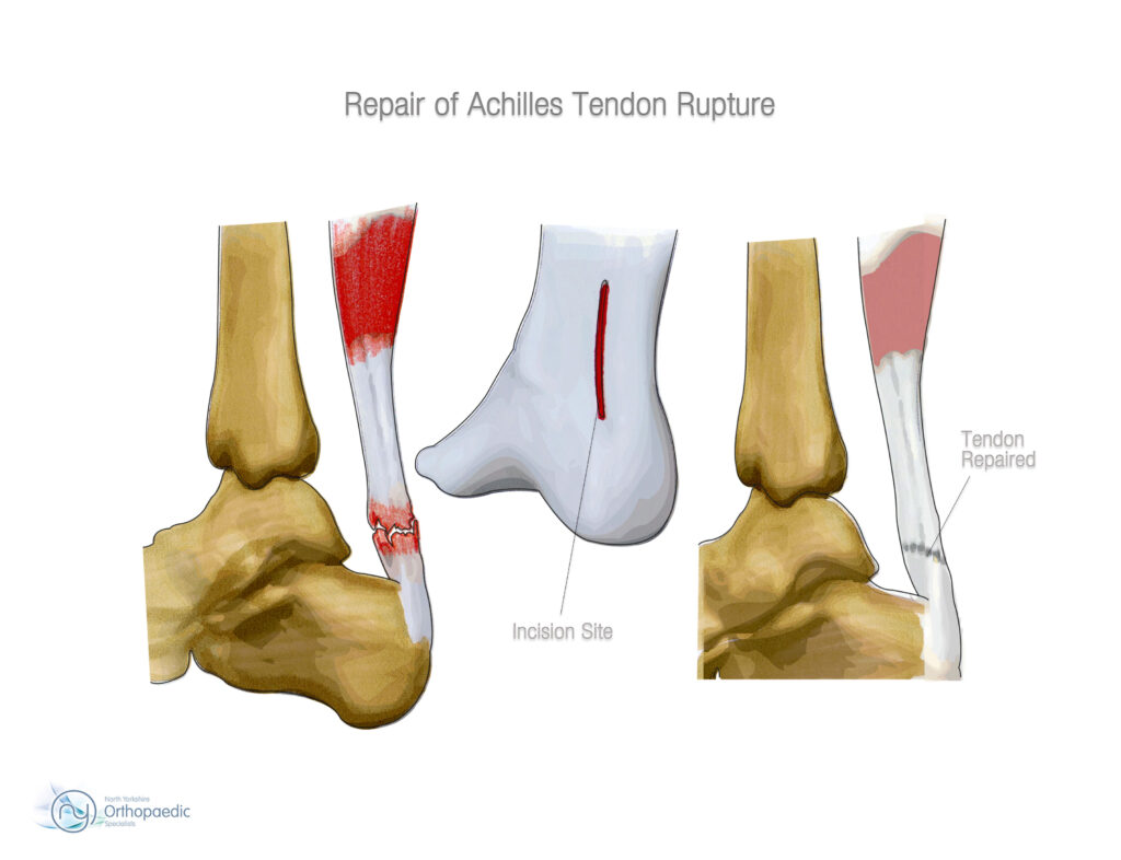 Achilles Tendon Repair