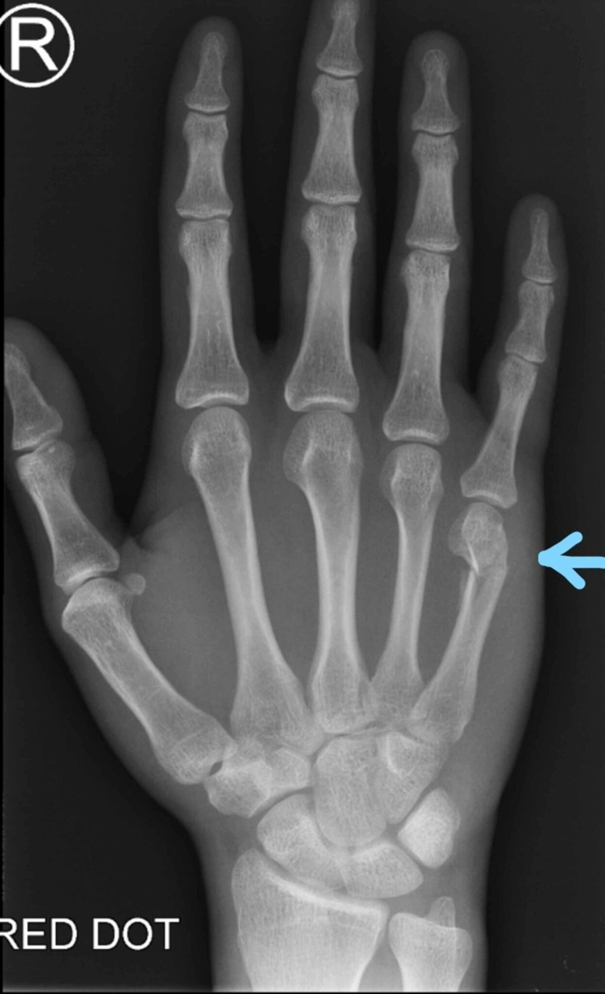 BOXER’S FRACTURE - MOTUS Physical Therapy