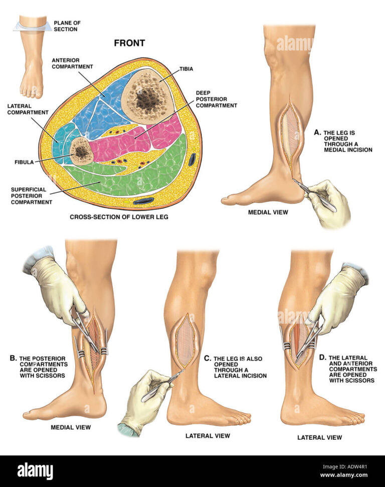 COMPARTMENT SYNDROME - MOTUS Physical Therapy