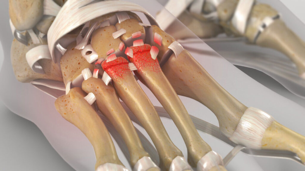 Lisfranc Fracture - Motus Physical Therapy