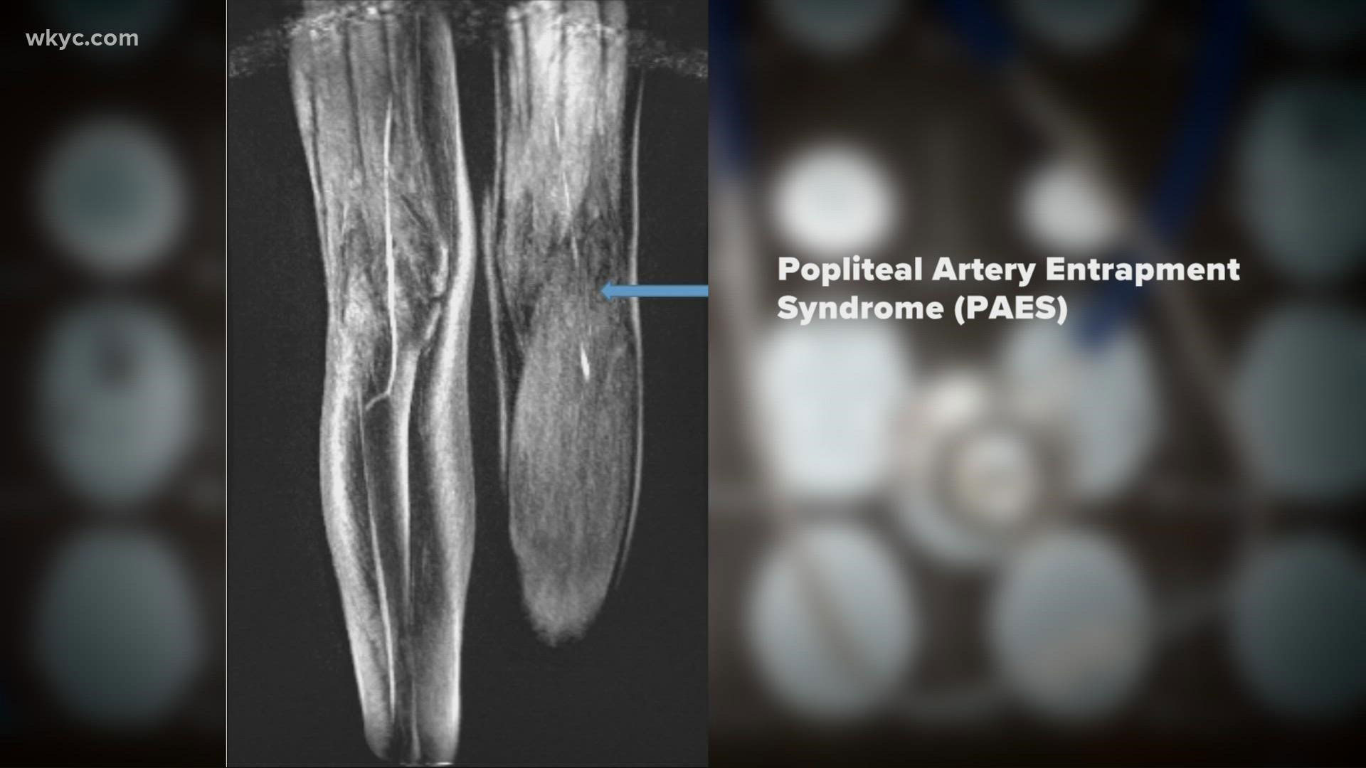 POPLITEAL ARTERY ENTRAPMENT SYNDROME (PAES) - MOTUS Physical Therapy