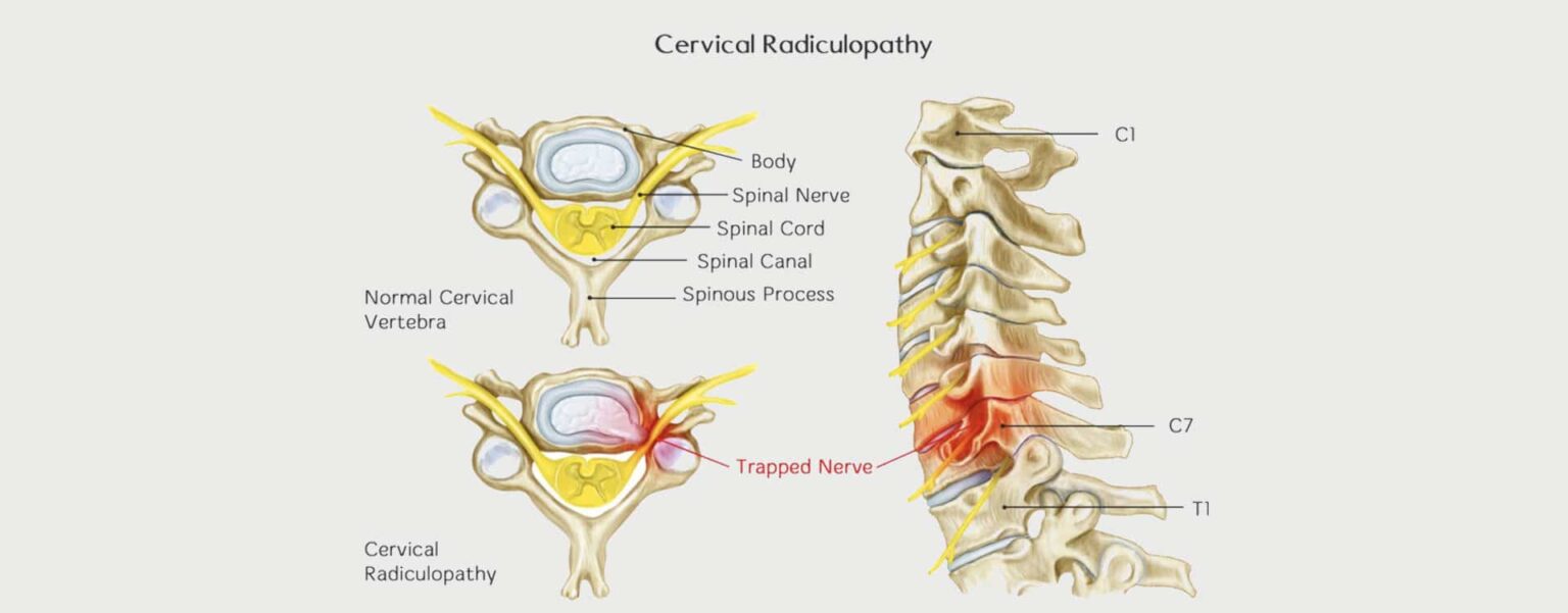 Cervical Radiculopathy - Motus Physical Therapy