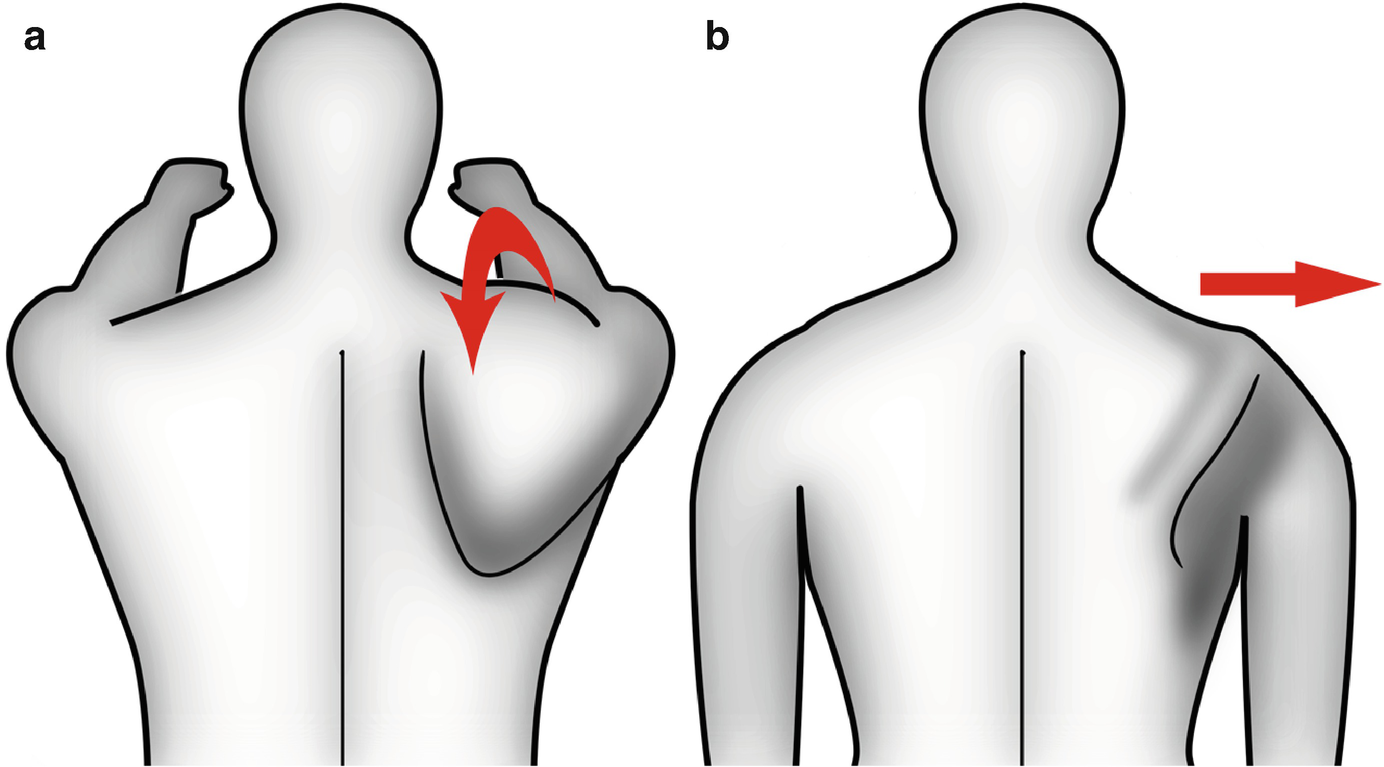 WINGING SCAPULA - MOTUS Physical Therapy