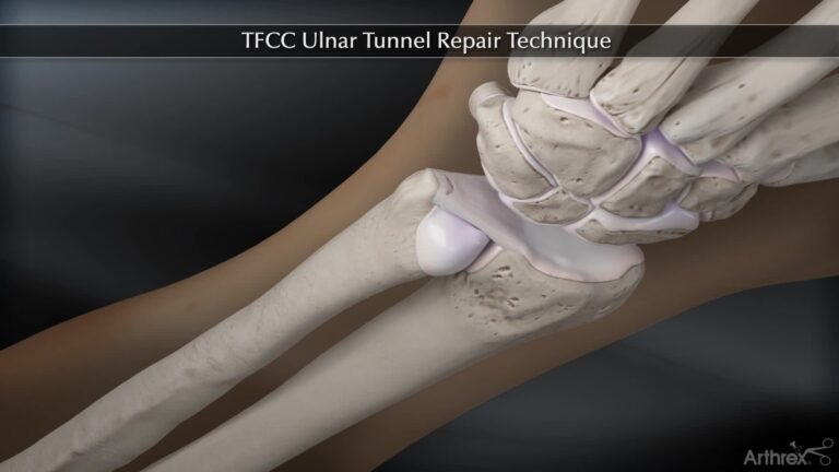 Triangular Fibrocartilage Complex Injury (TFCC) - Motus Physical Therapy